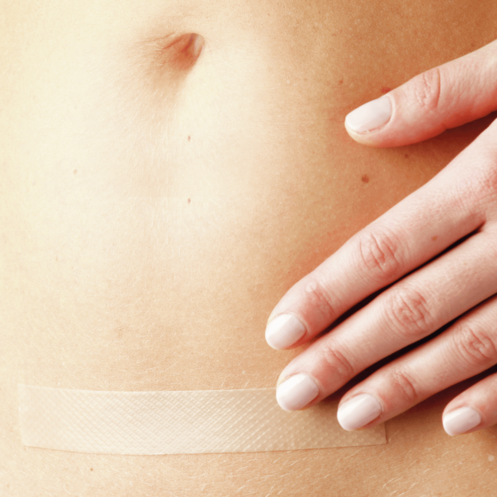 Skin Scar Remover Medical Soft Silicone Gel - Inspire Uplift