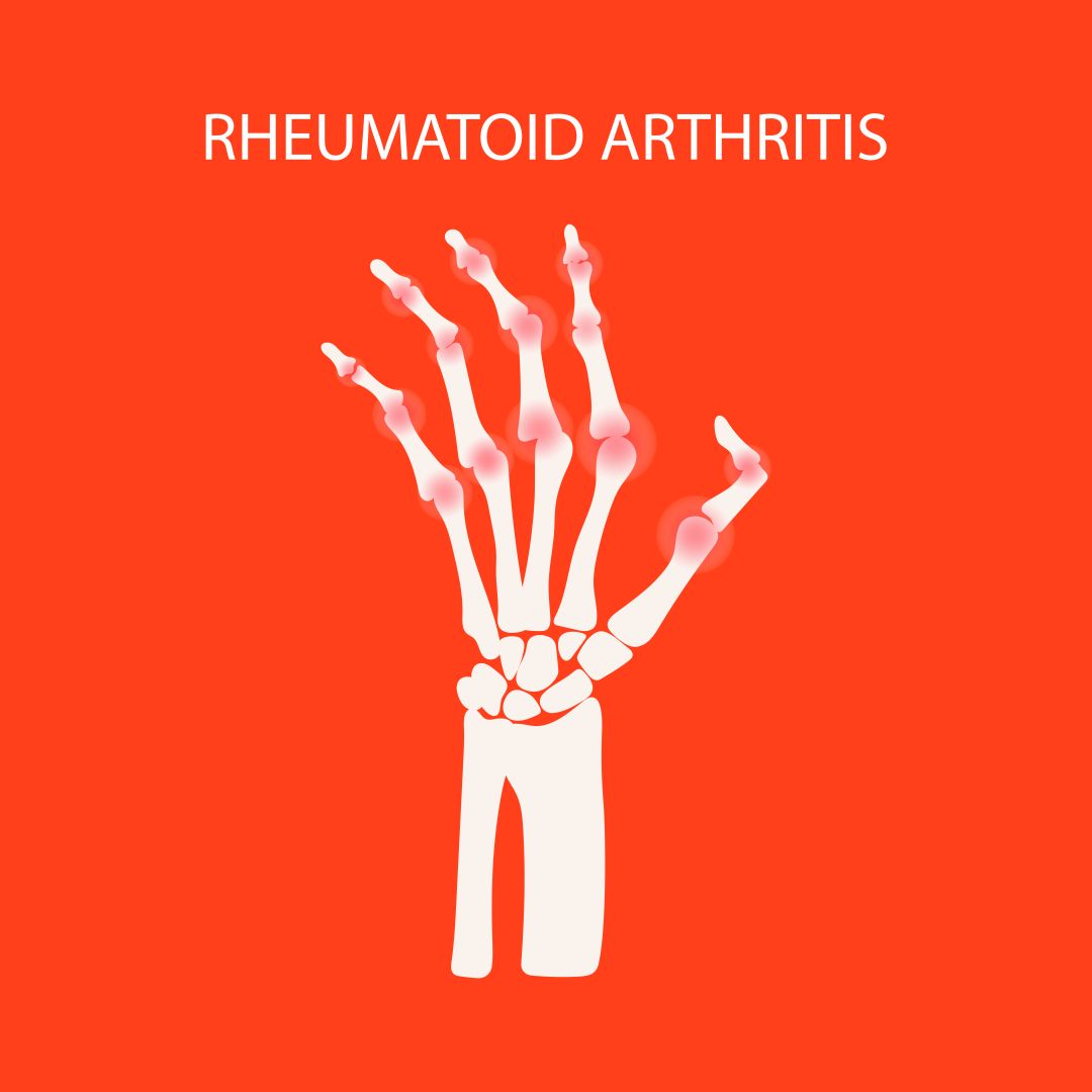 ARTHRITIS HAND VIDEO Rheumatoid Medicine Education Animation - Inspire ...