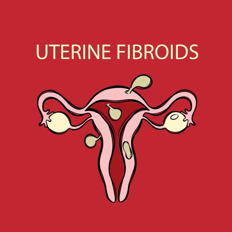 UTERINE FIBROIDS VIDEO Female Reproductive Anatomy Animation | Inspire ...