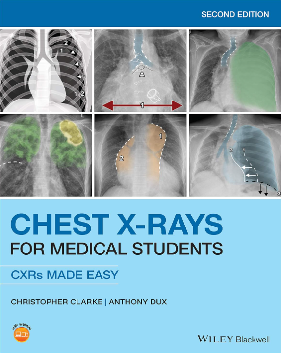 Chest X-Rays for Medical Students: CXRs Made Easy 2nd Editio | Inspire ...