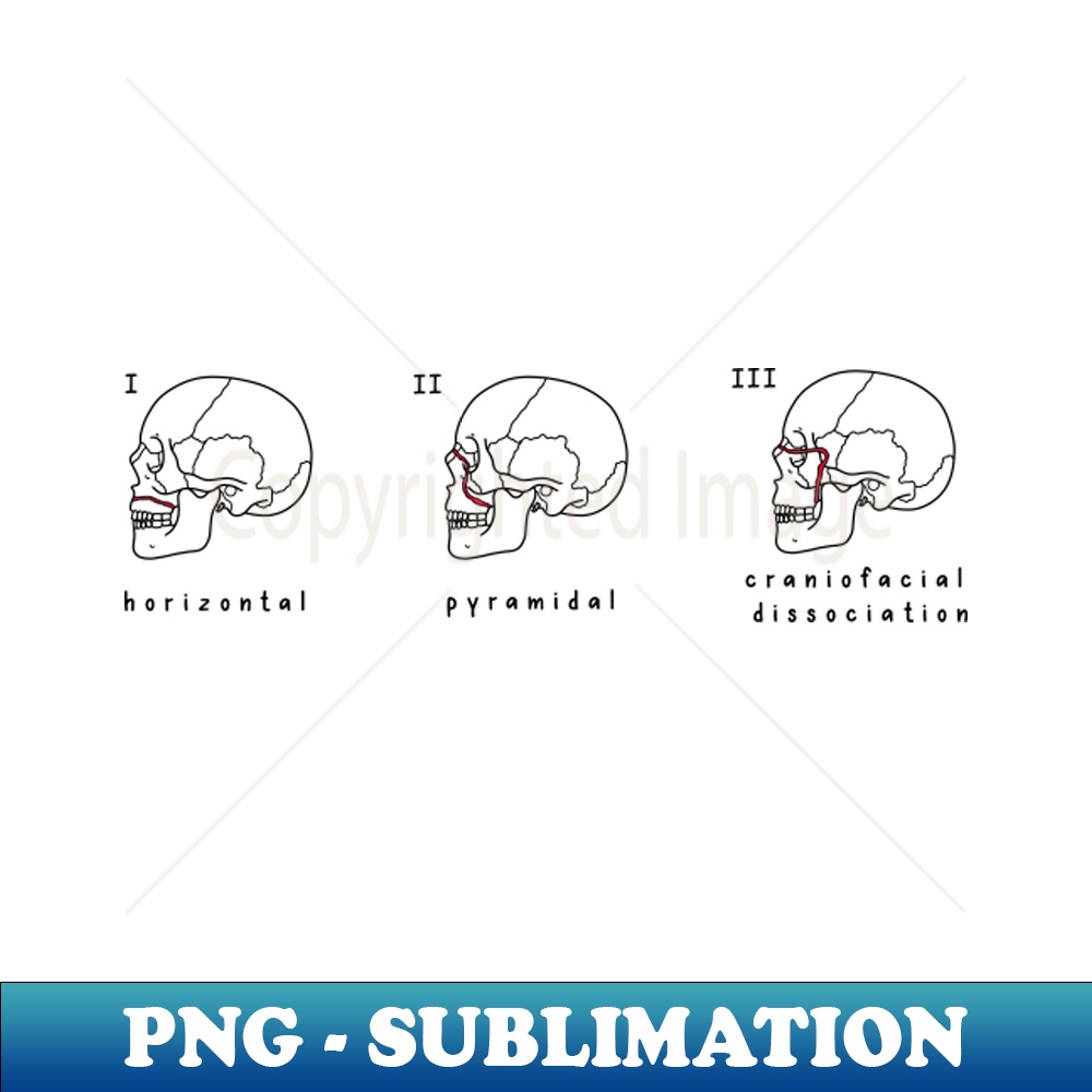 Hand Drawn Le Fort Facial Fractures Sagittal Plane - High-Qu - Inspire ...