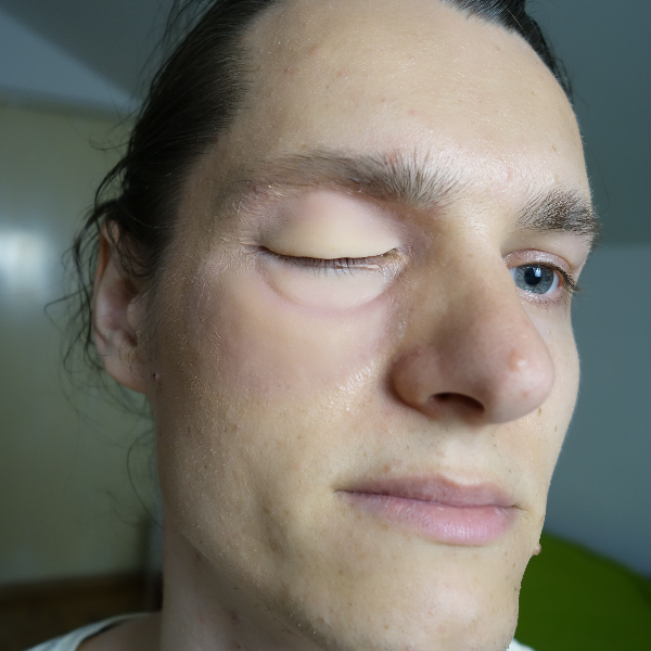 Silicone prosthetic makeup. Special effects makeup. Swollen | Inspire ...
