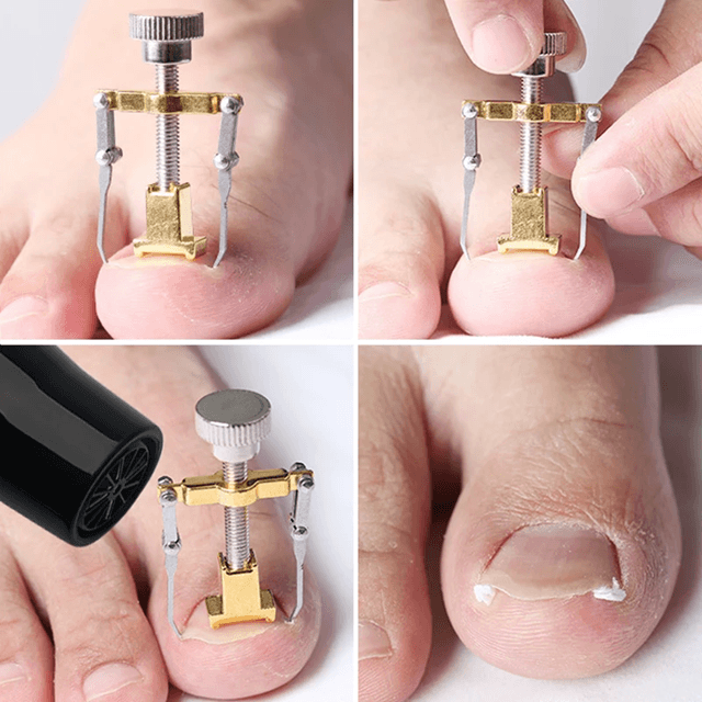 Professional Ingrown Toenail Corrector Clip and Stainless St | Inspire ...