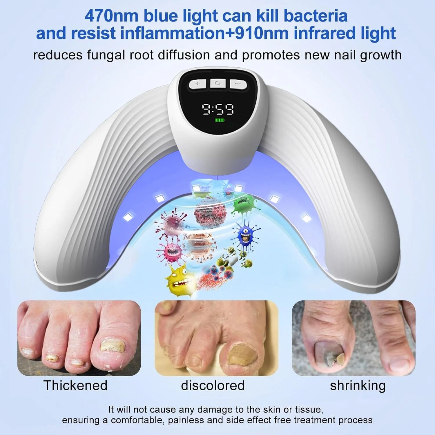 Laser Nail Fungus Treatment Device for Healthy Toenails and | Inspire ...